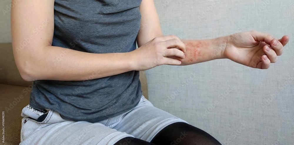 Woman with rash on her hands sitting on bed. Marburg virus, fever, red ...
