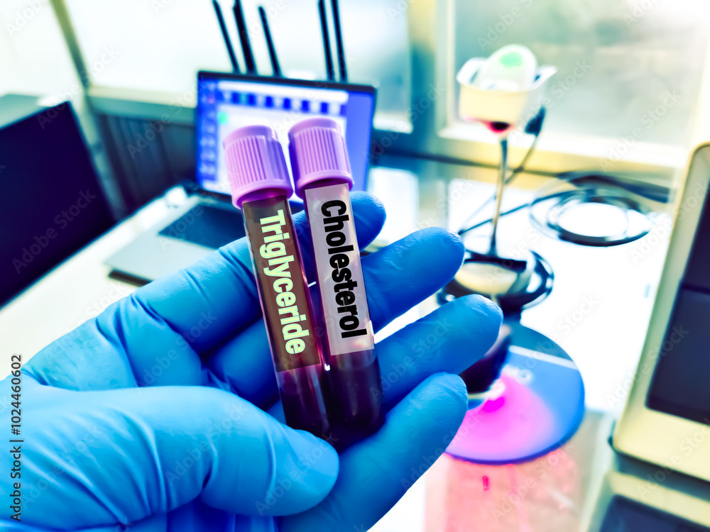 Blood samples for HDL Cholesterol (good cholesterol) and LDL ...