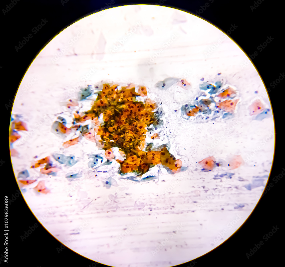 Light micrograph of a vaginal smear showing adenocarcinoma cells ...