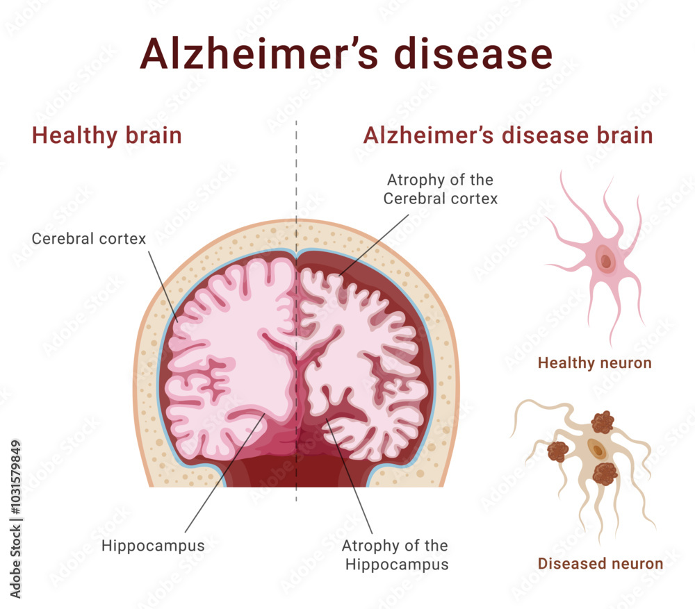 Healthy human brain and Alzheimer disease cross section infographic scheme vector flat Stock ...