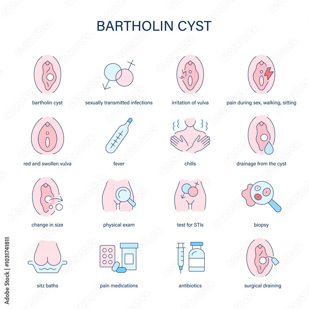 Bartholin Cyst symptoms, diagnostic and treatment vector icons. Medical ...
