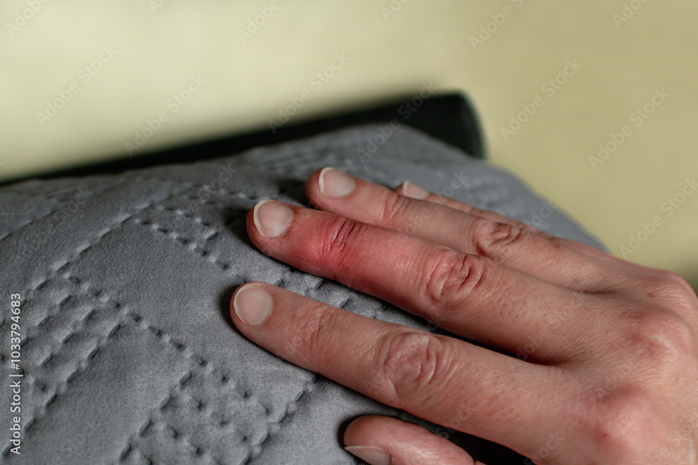 Mallet finger healing after splint removal from middle finger following ...