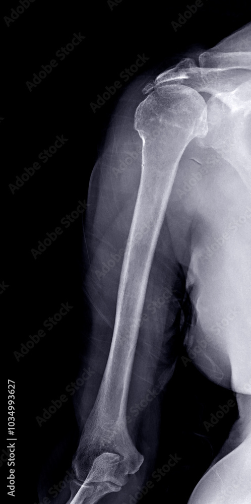 X-ray image of the humerus bone, showing proper alignment and no ...