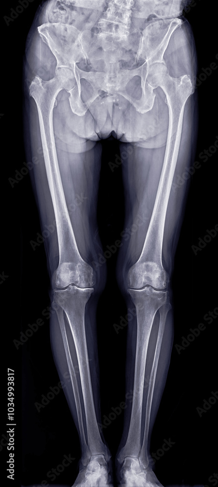 Scanogram image displaying the pelvis, femur, and tibia in alignment ...
