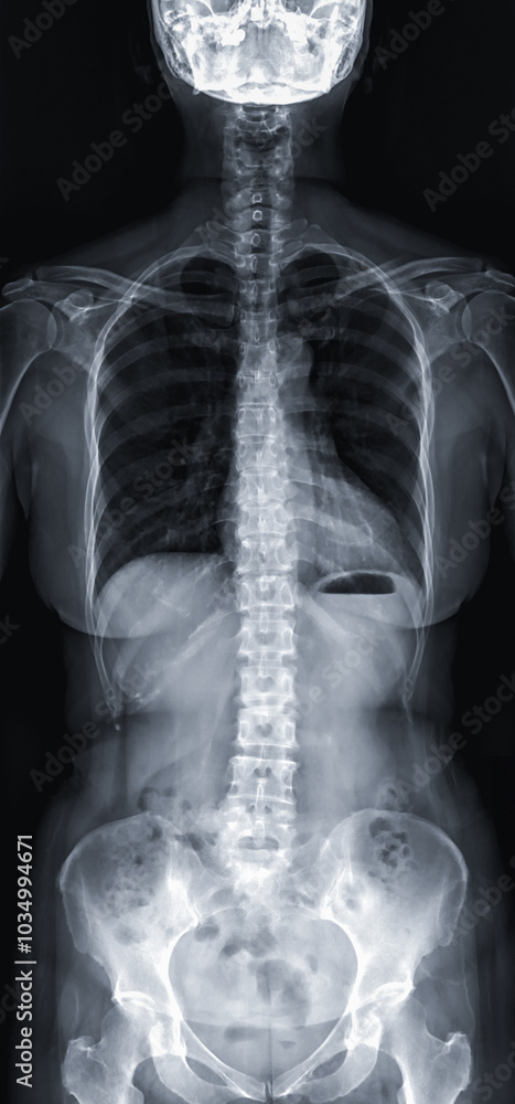X-ray image of the whole spine, showing cervical, thoracic, and lumbar ...