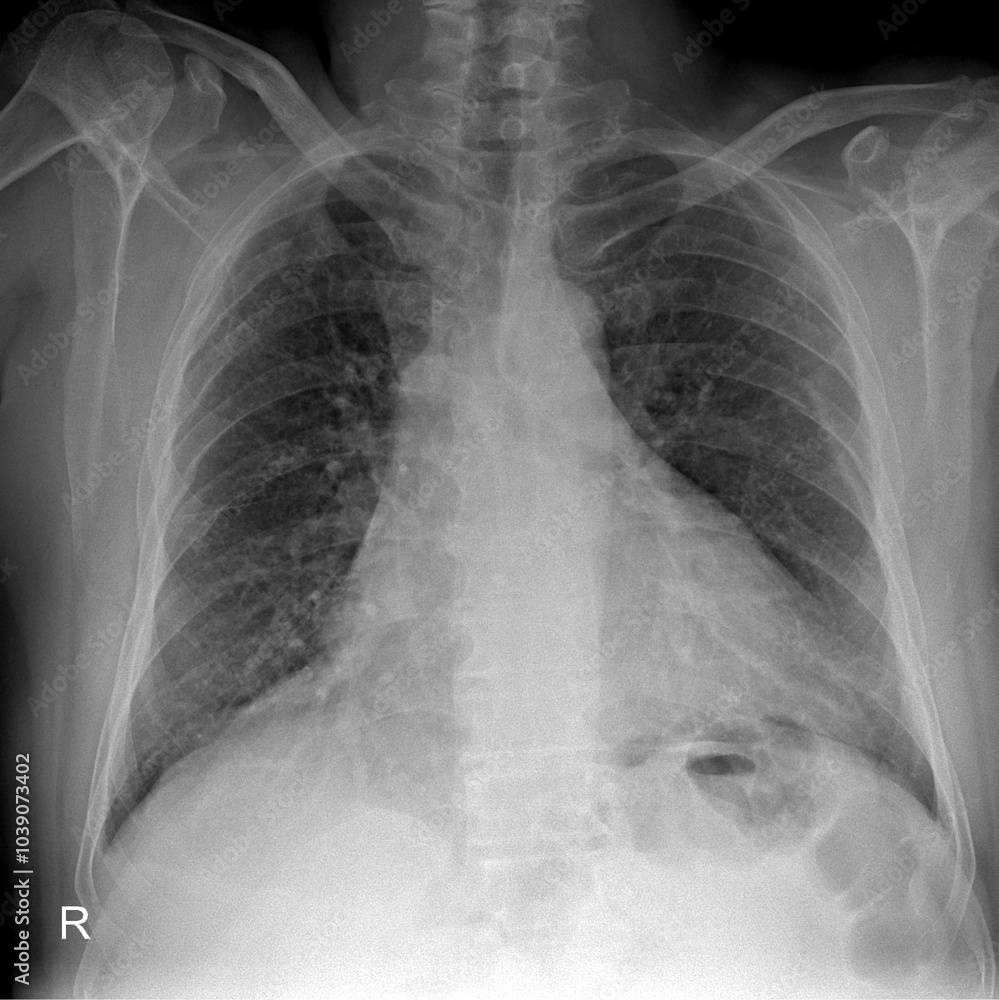 Chest X-ray for Comprehensive Lung and Heart Health Evaluation Stock ...