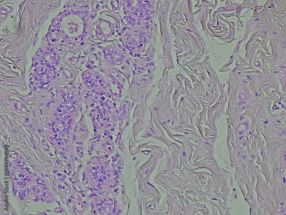 Human cervical cell tissue under microscope in pathology laboratory ...