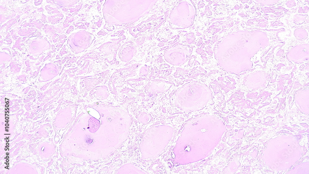 Photomicrograph showing histology of a benign thyroid nodule in a ...