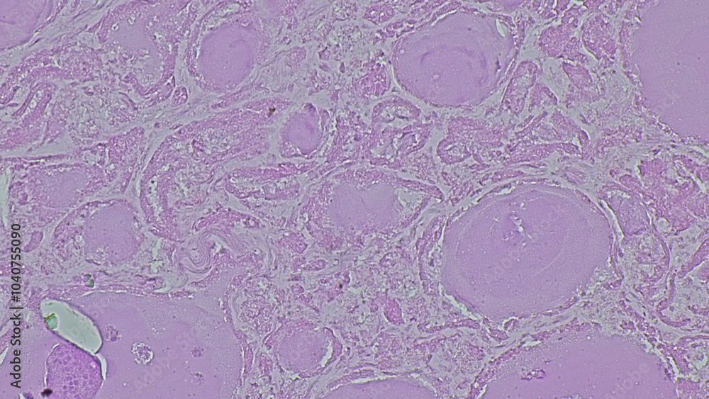 Photomicrograph showing histology of a benign thyroid nodule in a ...