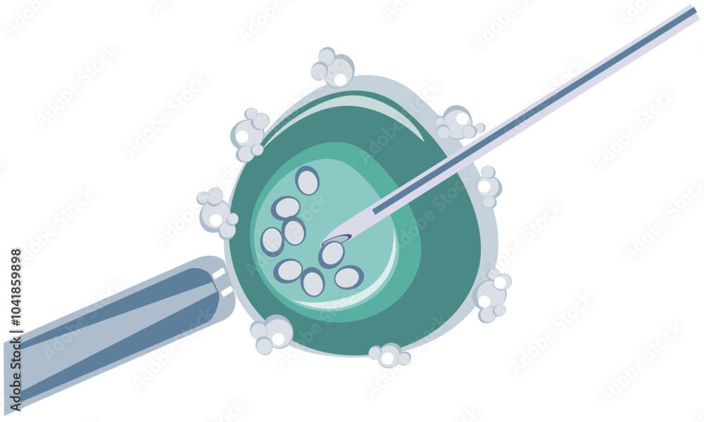 Transvaginal puncture of follicles with a needle, collection of eggs ...