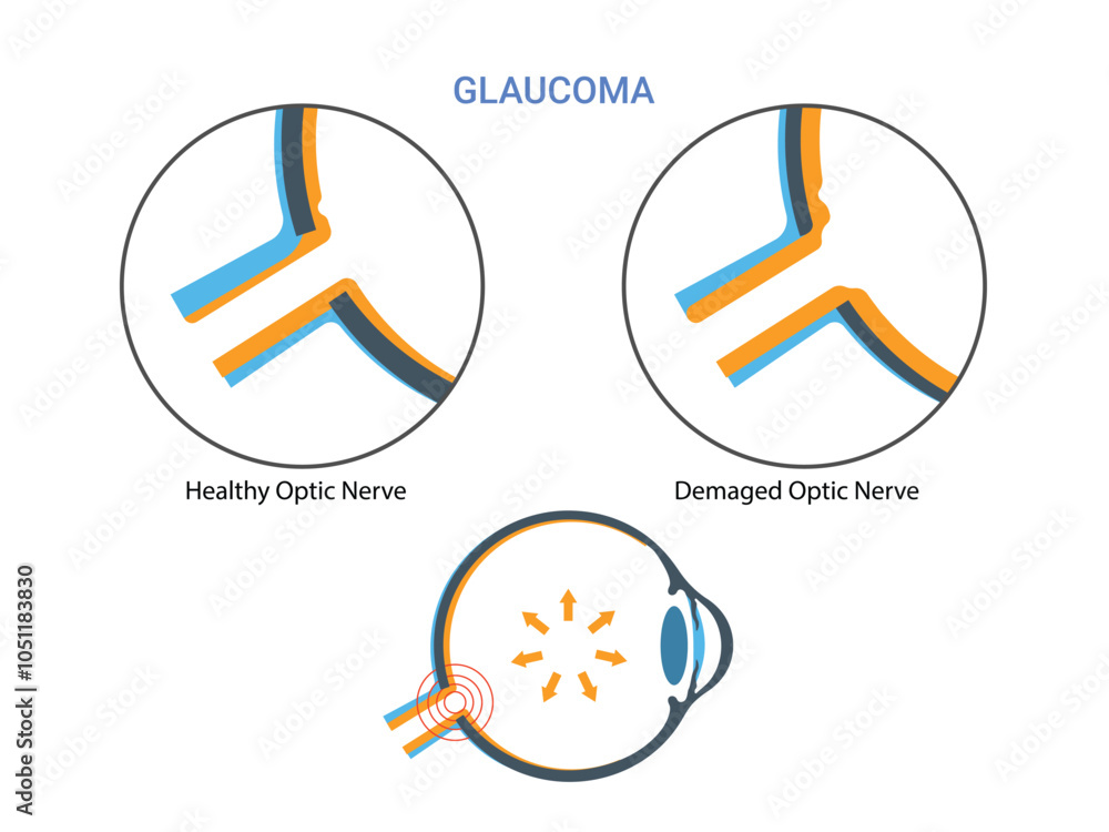 Glaucoma. Increased intraocular pressure, damaged optic nerve, vision ...