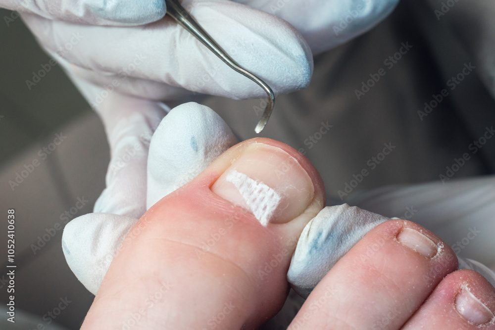 Medical pedicure, podiatrist doing tamponade to a deformed toenail ...