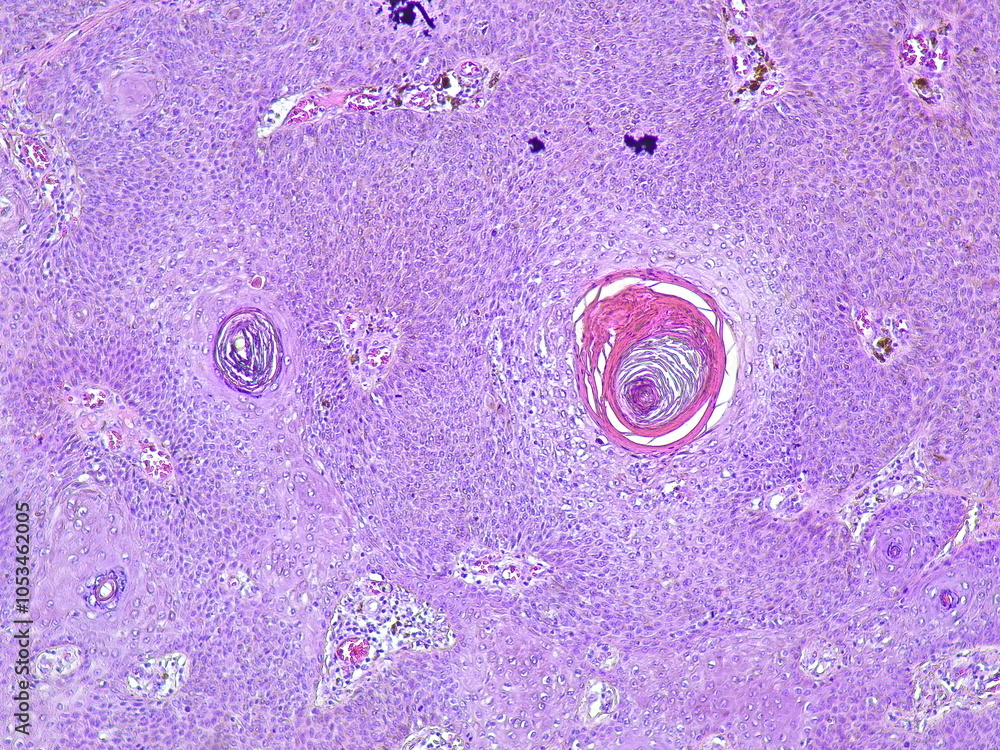 Photomicrograph seborrheic keratosis of the Skin, hematoxylin eosin ...