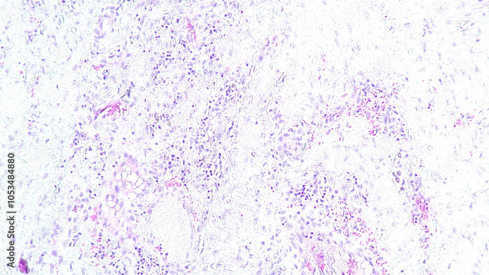 Foto de Stock image under the microscope of non-specific chronic ...