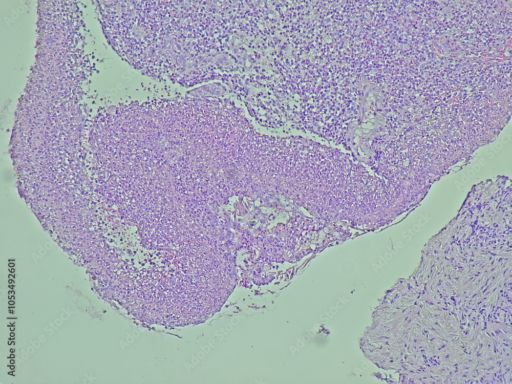 Photomicrograph of pyogenic granuloma, in rectal tumor under microscope ...