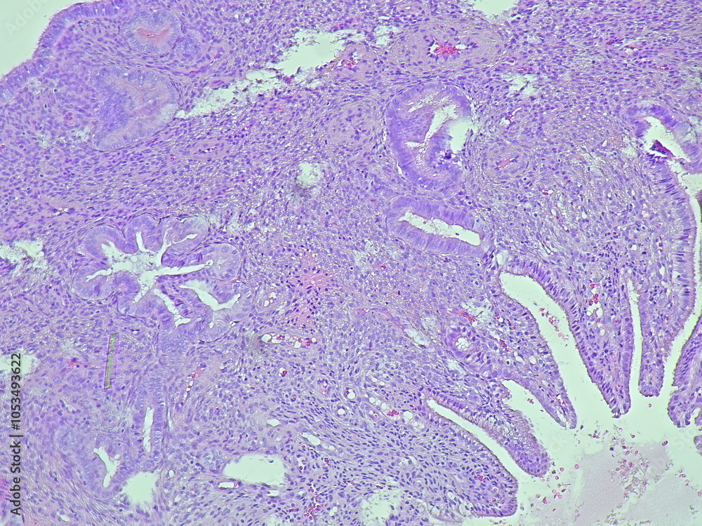 Foto de Stock Photomicrograph of an endocervical polyp under a ...