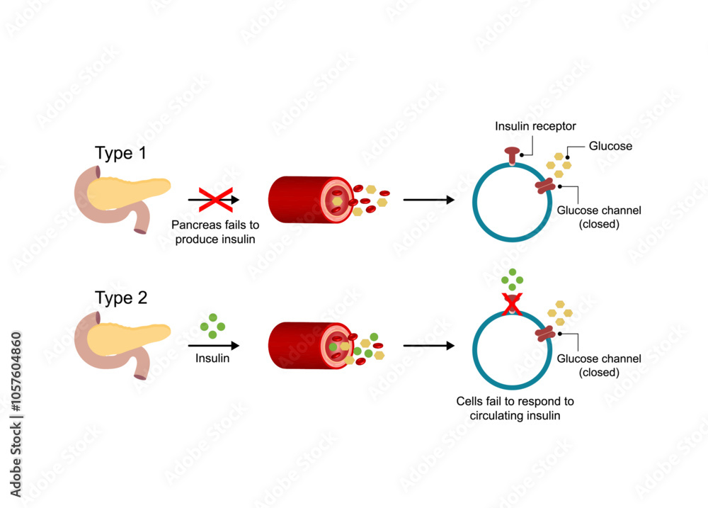 Diabetes mellitus type 1, pancreas's failure to produce enough insulin ...