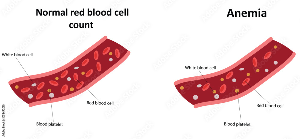 Anemia and normal red blood cell count vector illustration Stock Vector ...