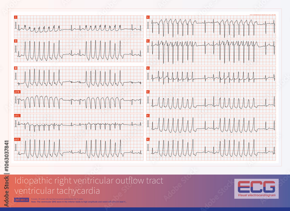 Idiopathic ventricular tachycardia originating from the right ...