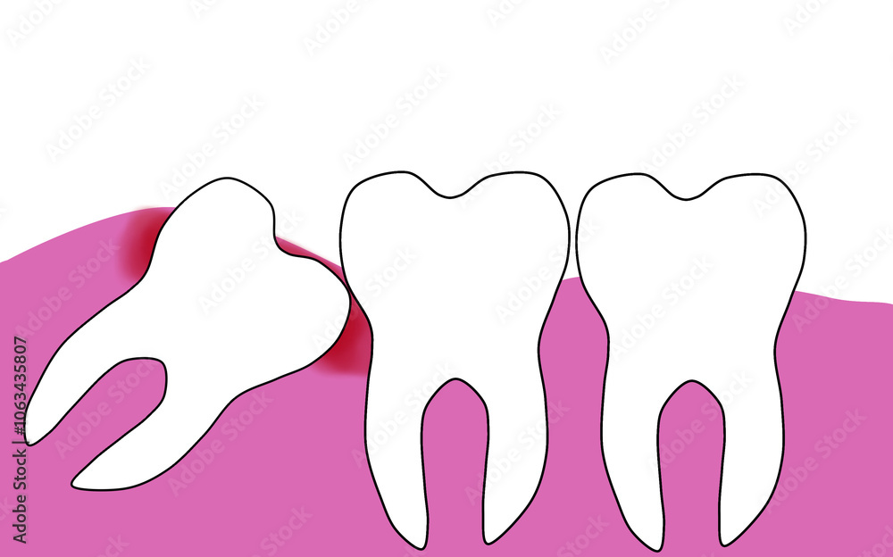 Impacted wisdom third molar tooth mesioangular classification swollen ...