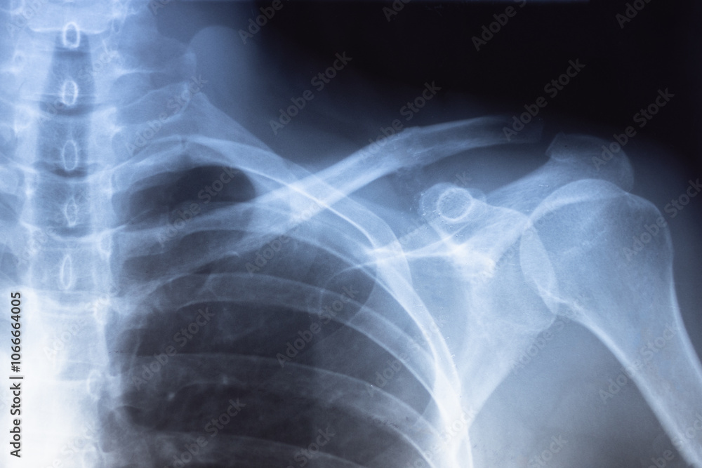 X-ray scan of Dislocation of the acromial end of the clavicle. Stock ...