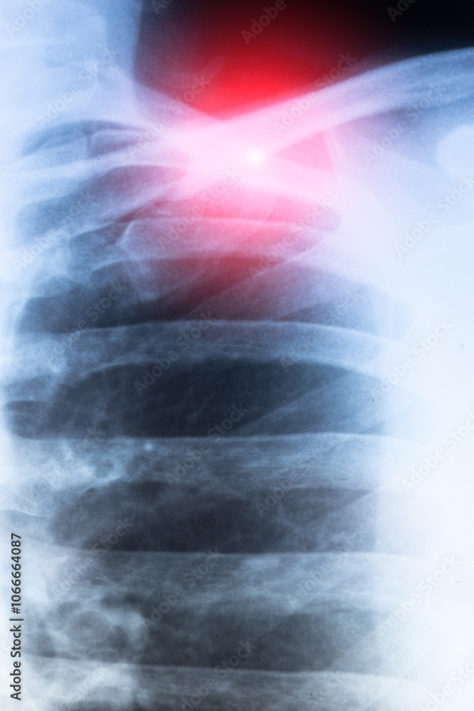 Vertical X-ray scan of Dislocation of the acromial end of the clavicle ...