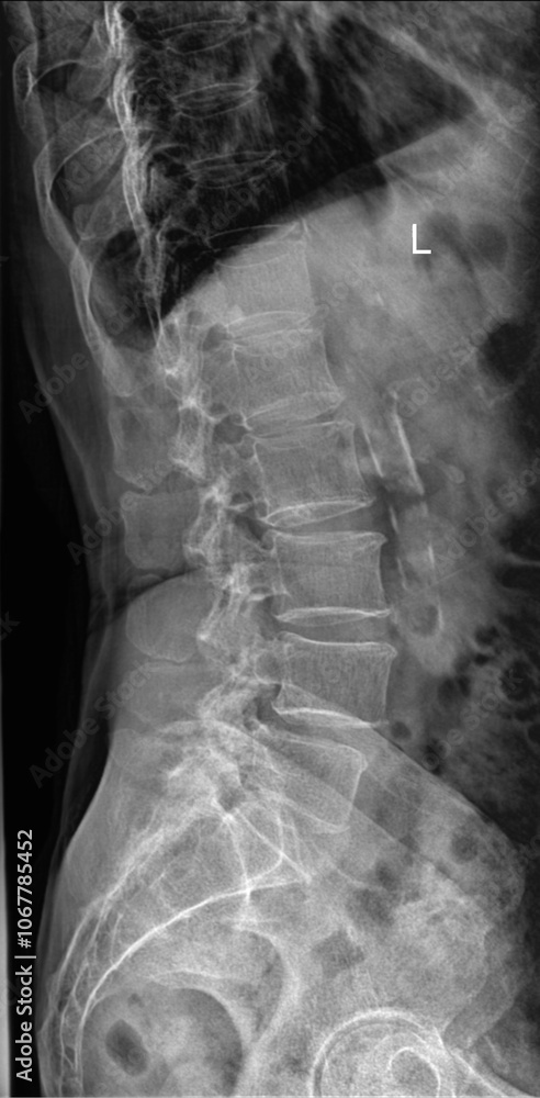 Lateral Radiograph of Lumbar Spine for Evaluation of Fracture and ...