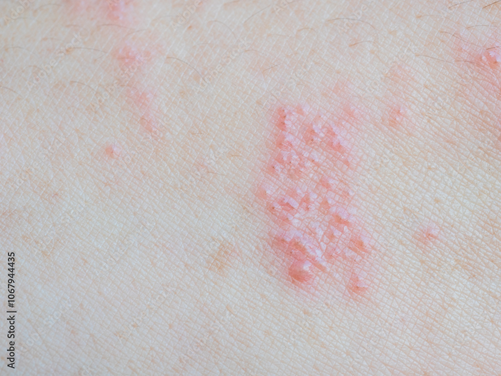 Shingles (Herpes Zoster, Shingles) is a type of skin disease. This is ...