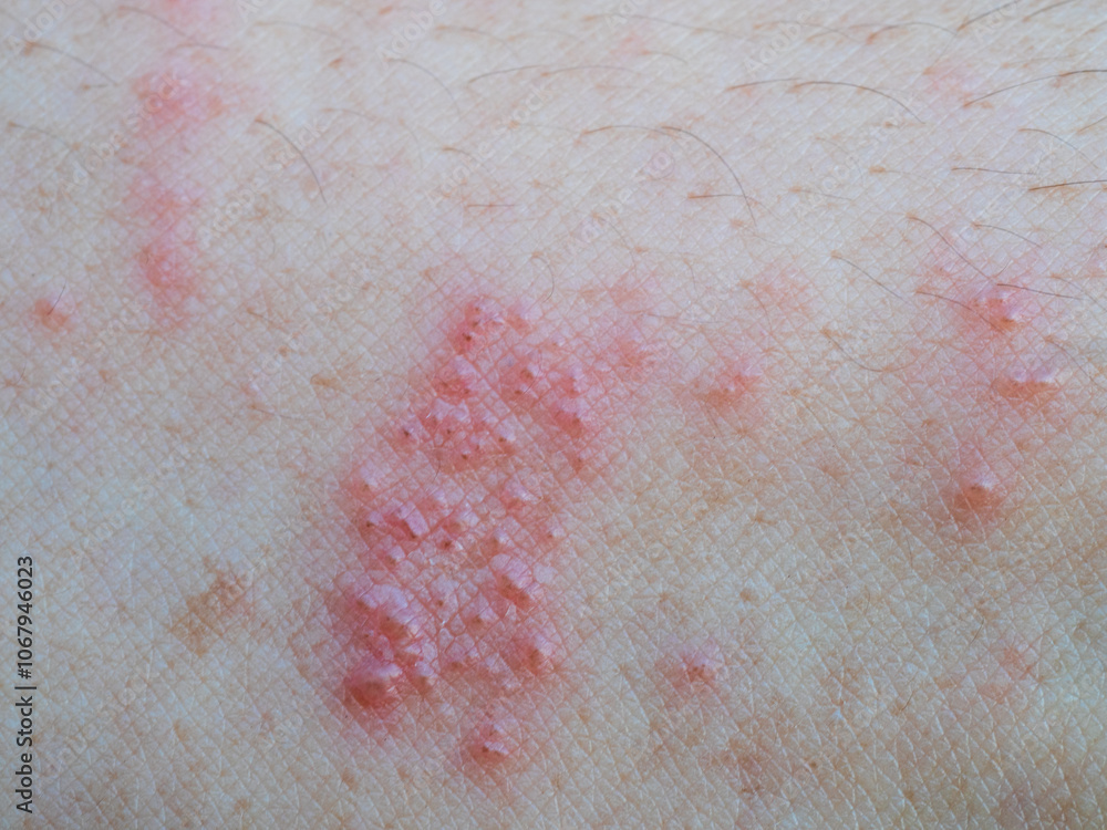 Shingles (Herpes Zoster, Shingles) is a type of skin disease. This is ...