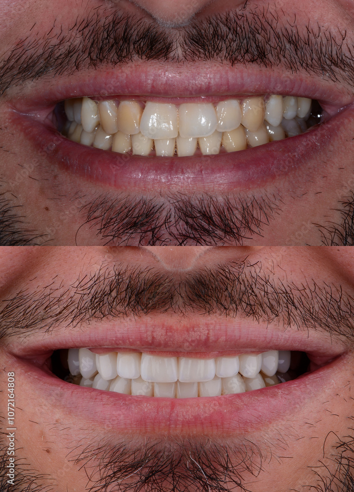 Male full smile makeover with ceramic ultra-thin natural looking ...