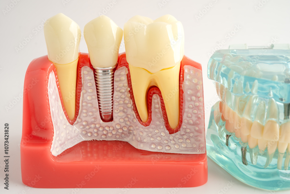 Dental implant, artificial tooth roots into jaw, root canal of dental ...