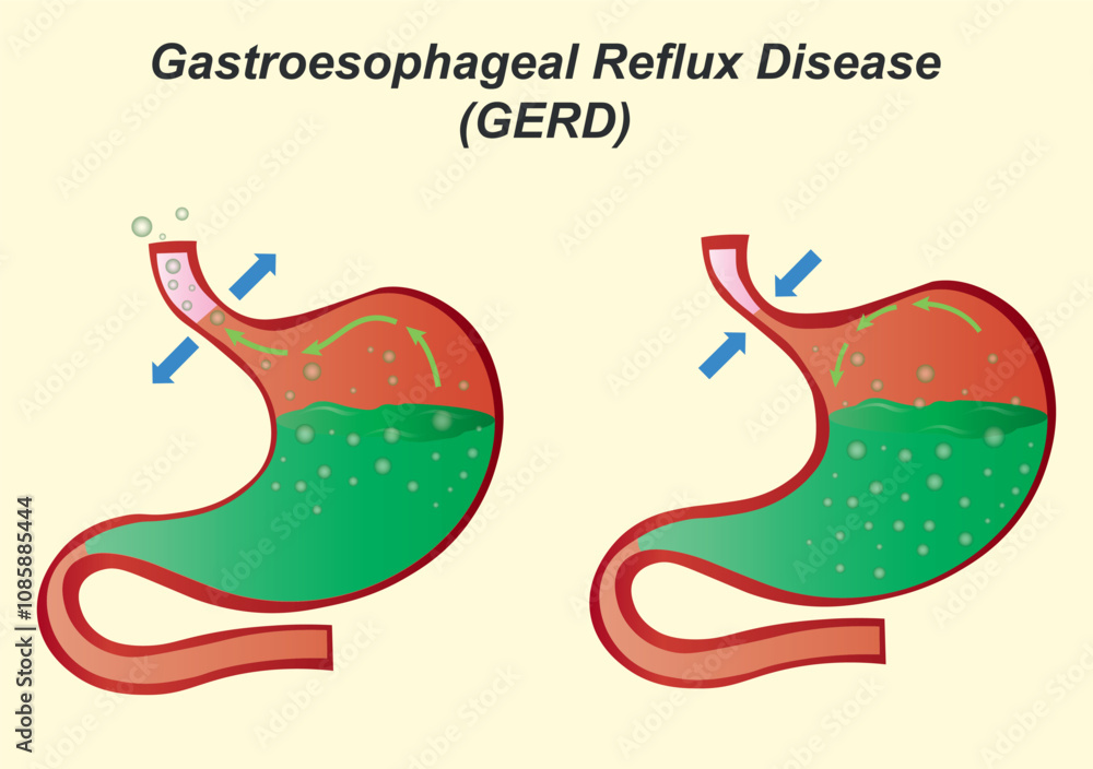 Gastroesophageal Reflux Disease GERD. Stomach anatomy structure ...