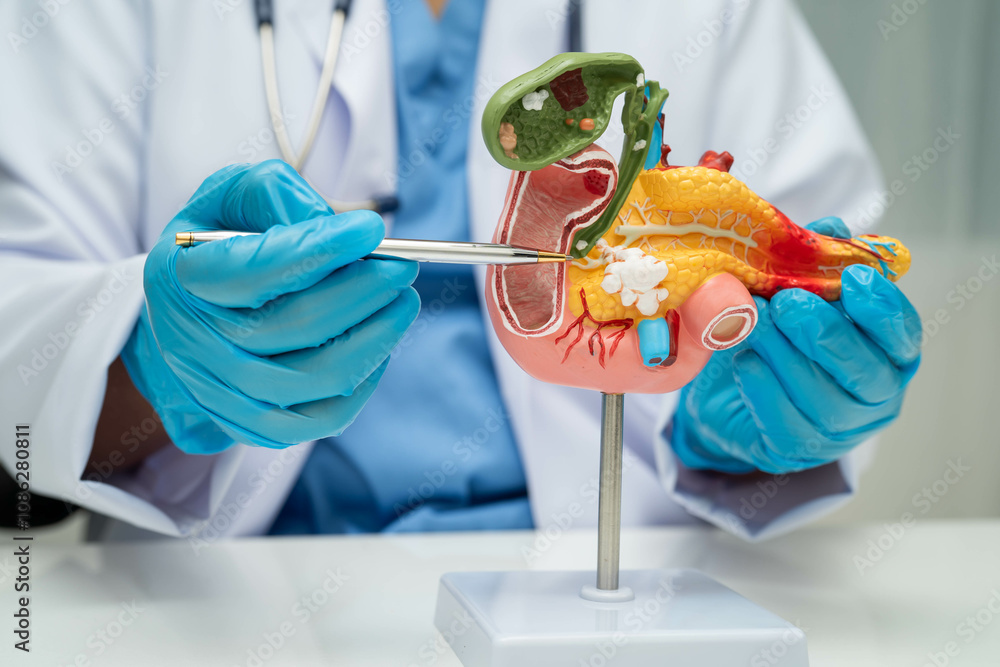 Pancreatitis, pancreatic cancer, Asian doctor with pancreas ...