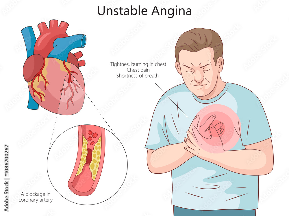 symptoms of unstable angina and blockage in coronary arteries causing ...