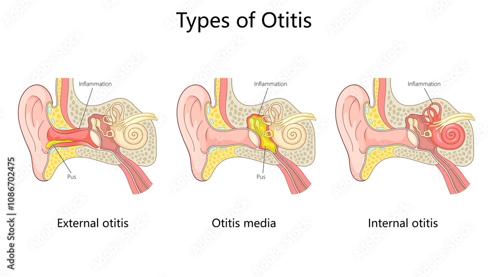 otitis ear infections external otitis, otitis media, and internal otitis with inflammation and ...