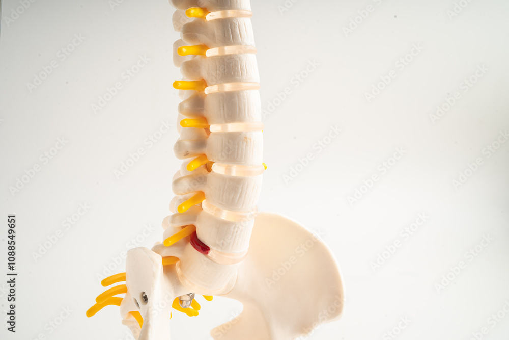 Lumbar spine displaced herniated disc fragment, spinal nerve and bone ...