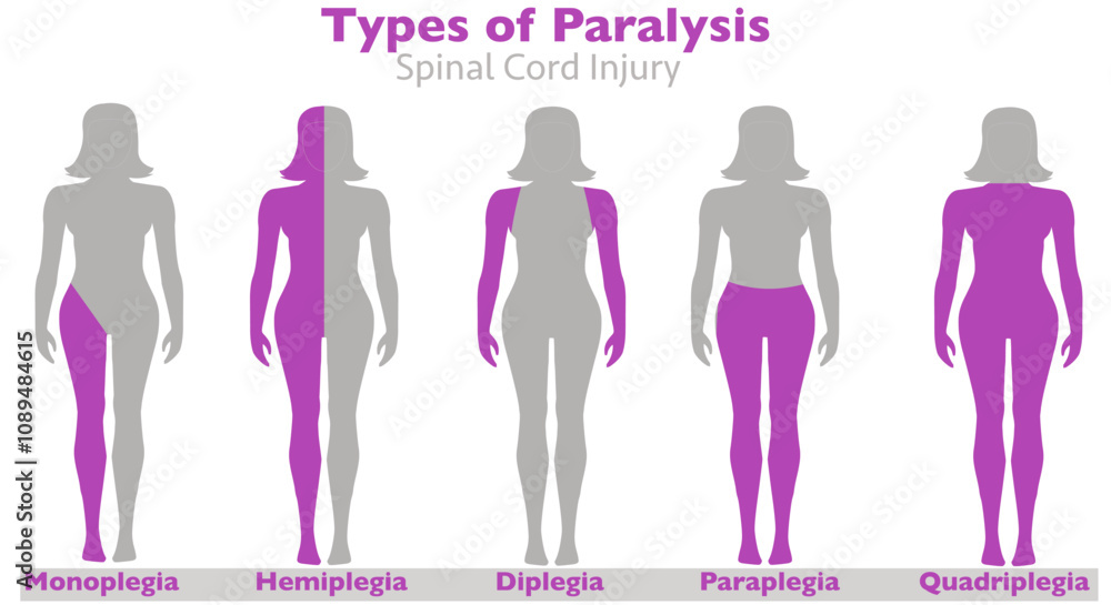 Palsy, spinal cord injury, paralysis types. Monoplegia, paraplegia ...
