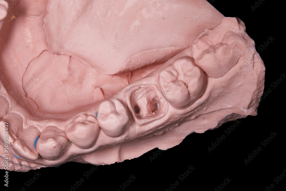 Plaster model mandibular arch part with decayed molar crown completely ...