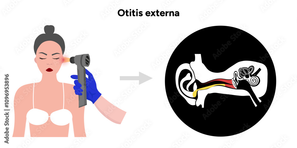 Otitis externa anatomy ear disease inflammation Stock Vector | Adobe Stock