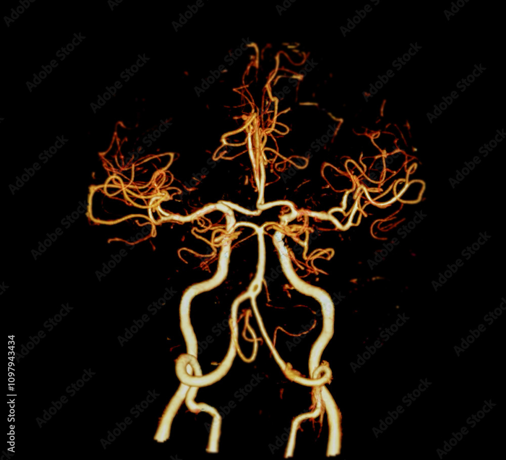 The CT Angiography (CTA) scan of the brain and neck, showcasing the ...