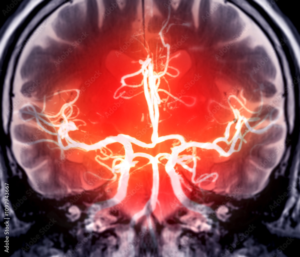 3d reconstruction; anatomy; aneurysm; angiogram; angiography; artery ...