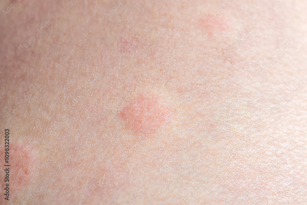 Skin allergy rash dermatitis texture close up background Stock Photo ...