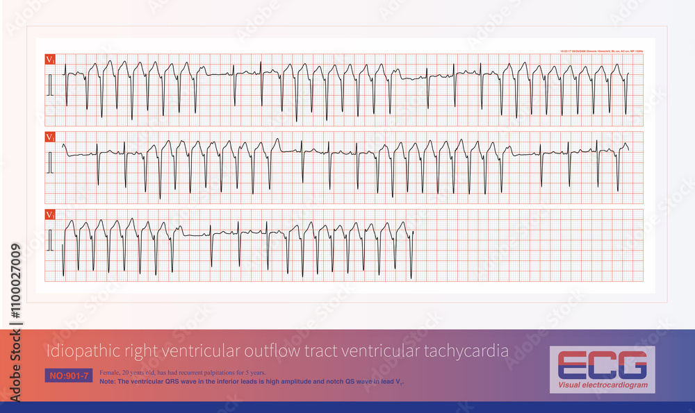Idiopathic ventricular tachycardia originating from the right ...