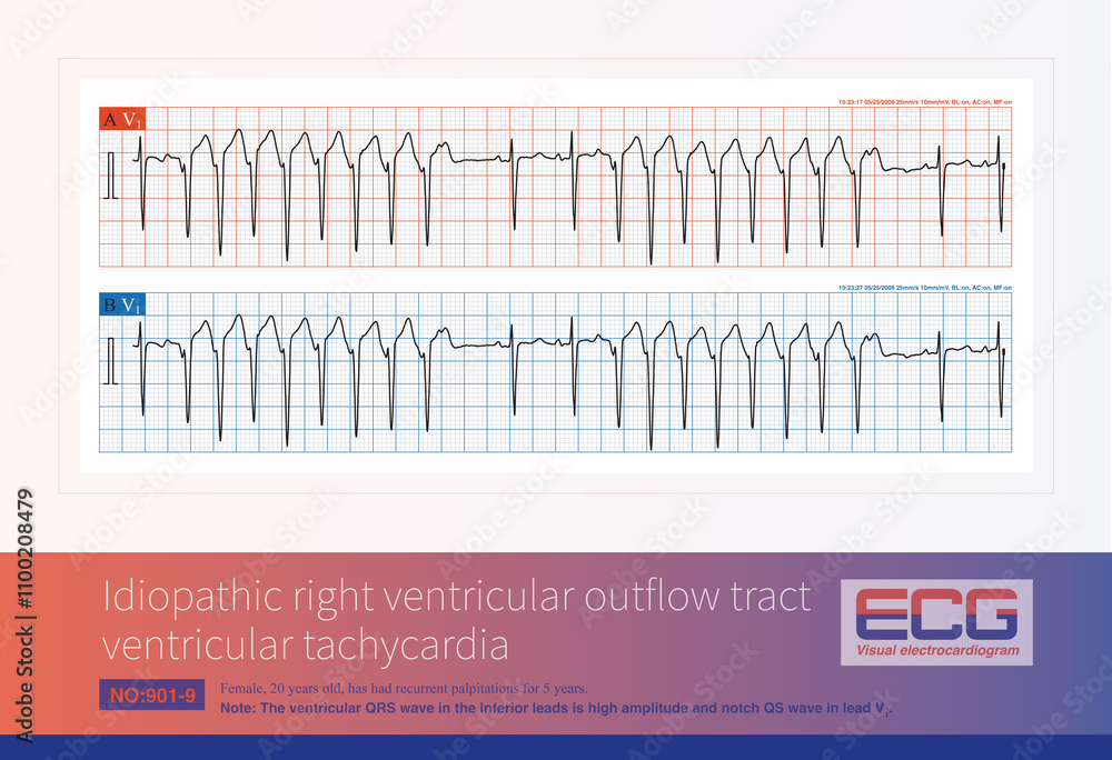 Idiopathic ventricular tachycardia originating from the right ...