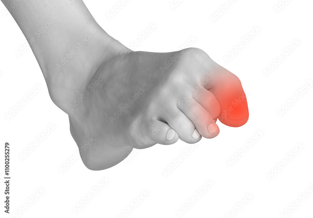 Big toe pain, joint ache, and inflammation. Sore, painful foot with ...