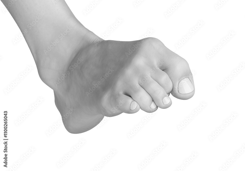 Gray foot with tense toes and ankle. Barefoot model showing inward ...