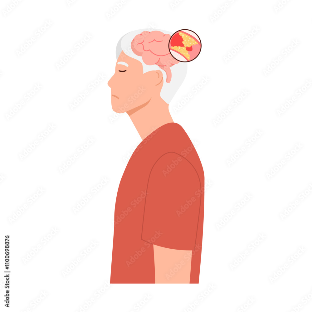 Man suffering from stroke. Ischemic stroke patient. brain with blood ...