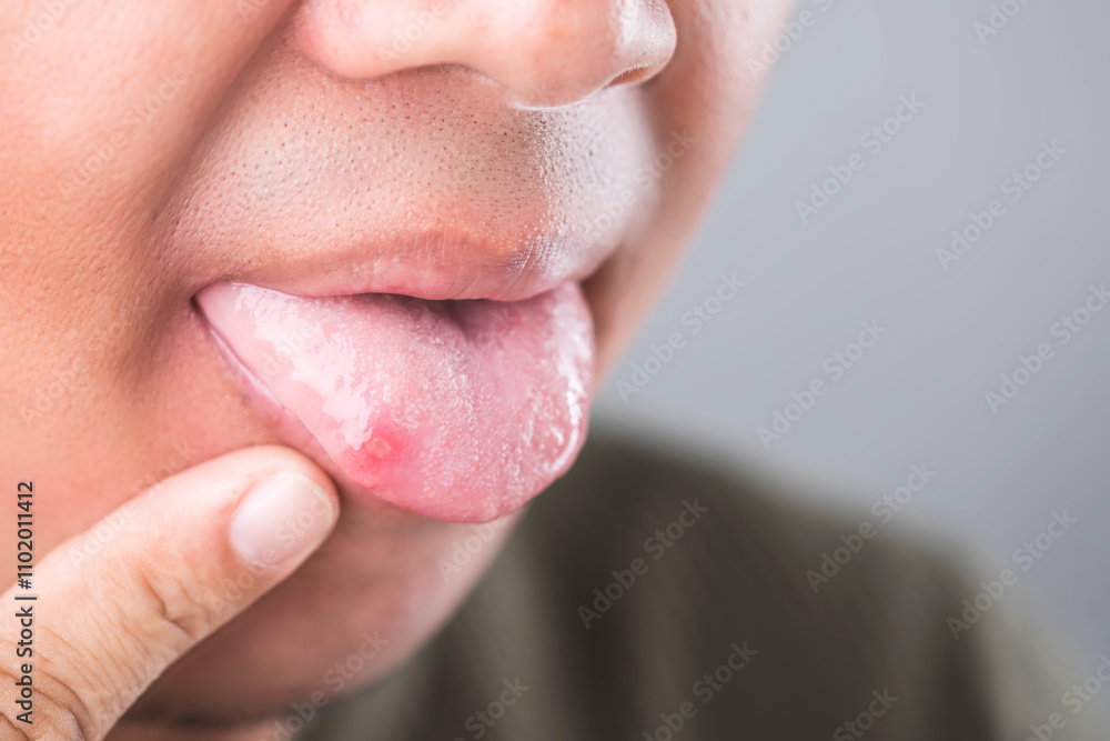 A patient's mouth showing an oral ulcer on the tip of the tongue, highlighting the discomfort ...