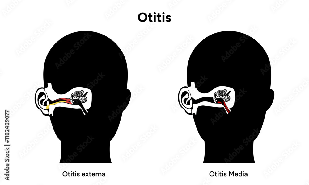 Otitis media and externa human ear anatomy disease medical infographic ...