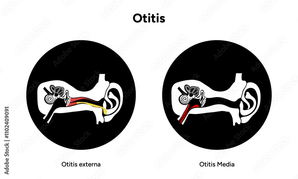 Otitis media and externa human ear anatomy disease medical infographic ...